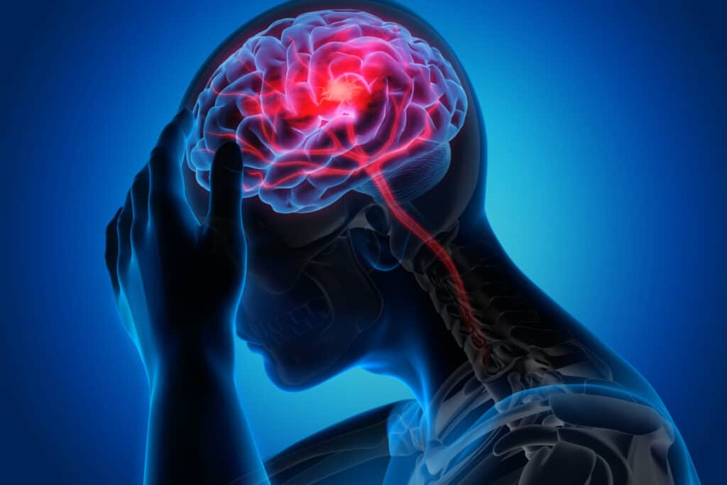 Recognizing and Treating the Psychological Effects of Stroke - Bancroft ...